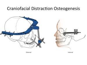 Craniofacial Surgery Royal Oak MI | Southfield